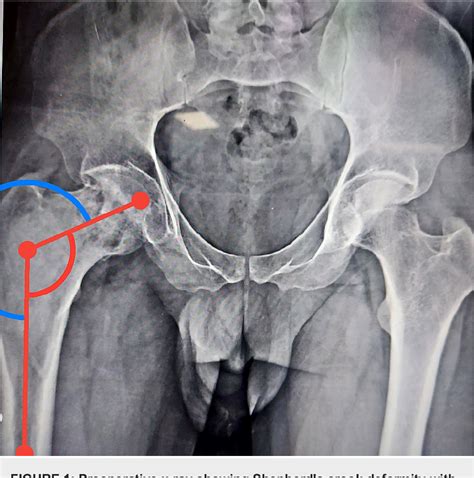 Figure 1 From Fibrous Dysplasia Of Proximal Femur A Case Report Of Treatment With Single Stage