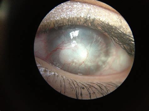 Corneal Neovascularization And Scarring Due To Over Wearing Contact Lenses Photo By Jim