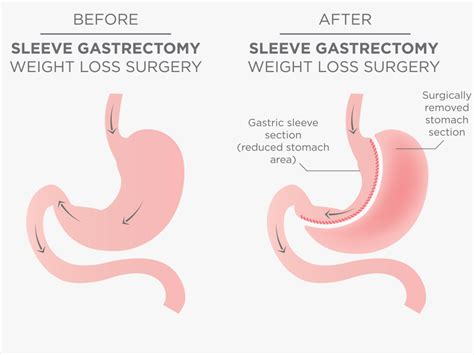 Partial Gastrectomy Procedure