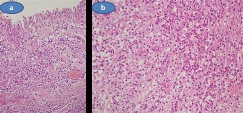A A Diffuse Infiltrate Of Histiocytes With Foamy Or Granular Cytoplasm