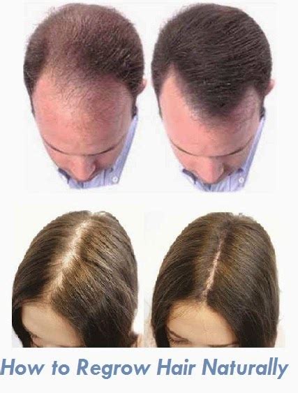 How To Regrow Hair Naturally Active Home Remedies