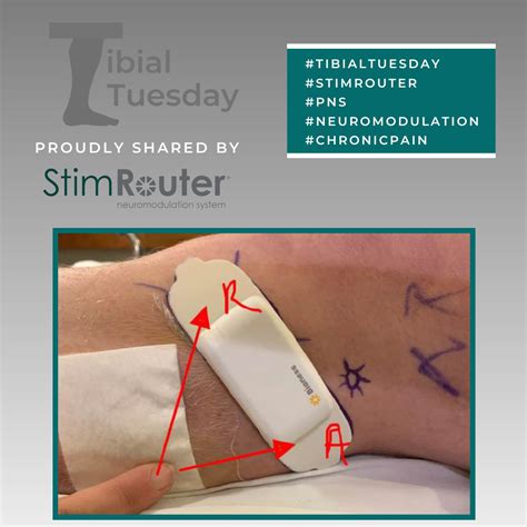 Stimrouter Pns System On Linkedin Tibialtuesday Stimrouter Pns