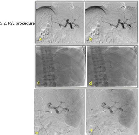 Embolization Procedure Dsa Of The Celiac Trunk And Splenic Artery Download Scientific Diagram