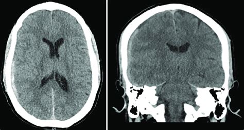 Outside Hospital Head Computed Tomography Demonstrating A Right Download Scientific Diagram