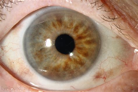 Atlas Entry Ocular Melanocytosis