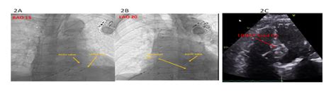 Successful Management Of Syncope And Sustained Ventricular Tachycardia Fibrillation In A