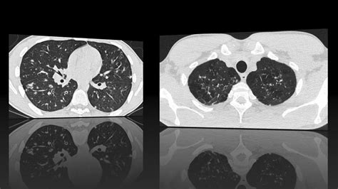 Tree In Bud Radiology Assistant Vertie Frick