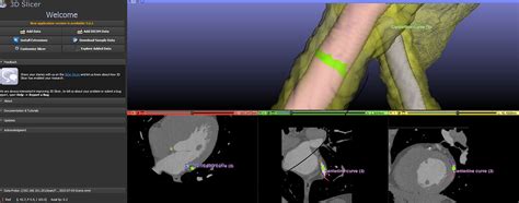 Extract Ras Coordinates By Clicking Support 3d Slicer Community
