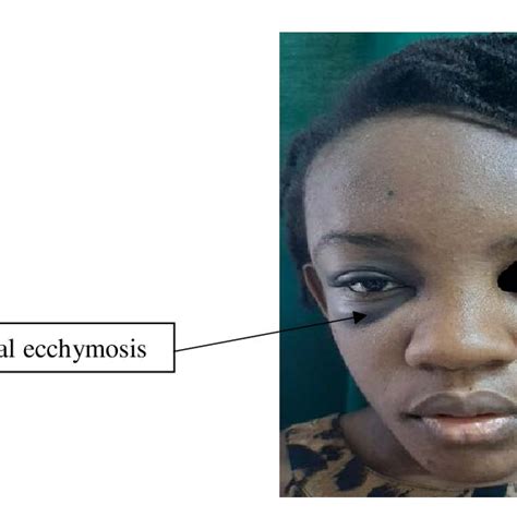Right Periorbital Ecchymosis Download Scientific Diagram