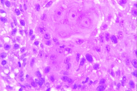 Lymph Node Under Low Power Field Figure 4 Computed Tomography Scan Of