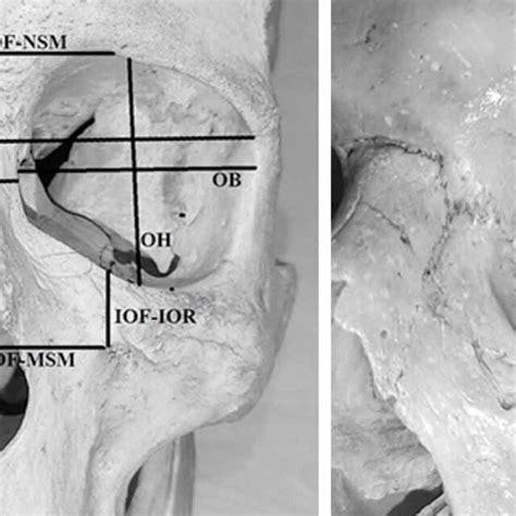 Sof Supraorbital Notch Foramen Iof Infraorbital Foramen Pa Download Scientific Diagram