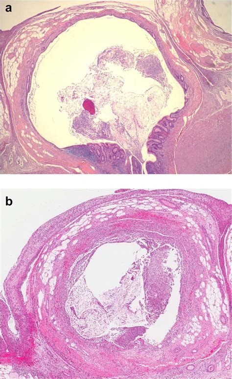 A Longitudinal Section Of Appendix Shows Pseudodiverticulum B