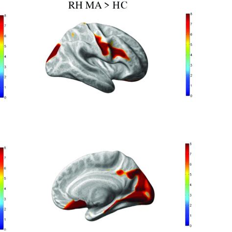 Group Differences Healthy Controls Hc Vs Ma P