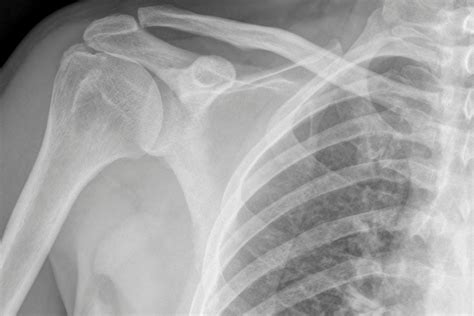 Heal A Rotator Cuff Without Surgery Emily Frye Homeopathy