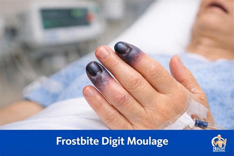 Frostbite Digit Moulage