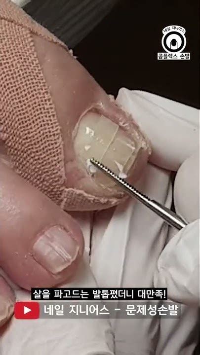 내가 살을 파고드는 발톱을 한번 펴볼게~ 얍 Shorts Youtube