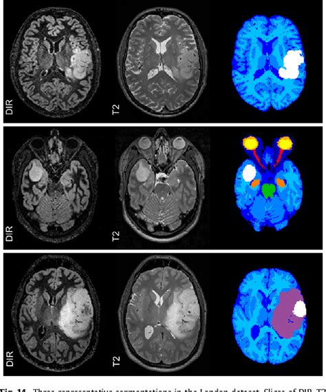 Figure 14 From A Modality‐adaptive Method For Segmenting Brain Tumors
