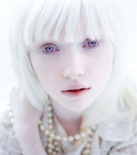 Eye Color Albino At Calvin Hartnett Blog