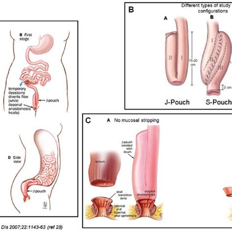 Restorative Proctocolectomy And Ileoanal Pouch Anastomosis AA D Download Scientific Diagram