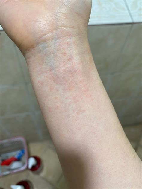 이 두드러기 급성 알러지인가요 지식in