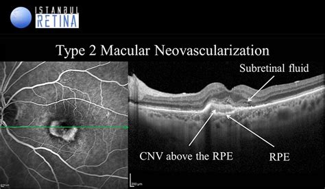 Age Related Macular Degeneration Oct Club
