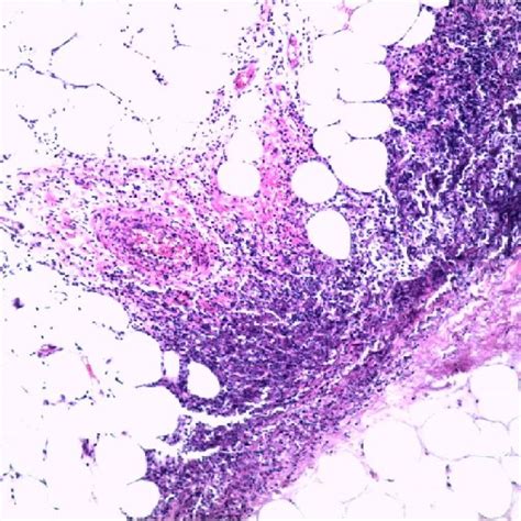 Pyoderma Gangrenosum Large Purulent Ulcer With Violaceous Undermined Download Scientific