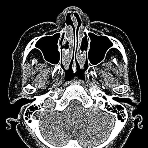 Cbct Skull Head And Neck Cts