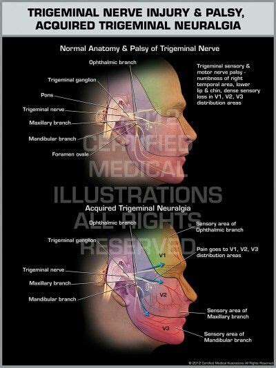 Atypical Trigeminal Neuralgia Artofit
