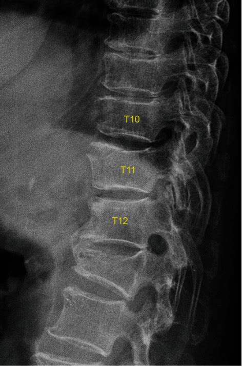 Follow Up Lateral Radiograph Of The Thoracolumbar Spine The Fracture