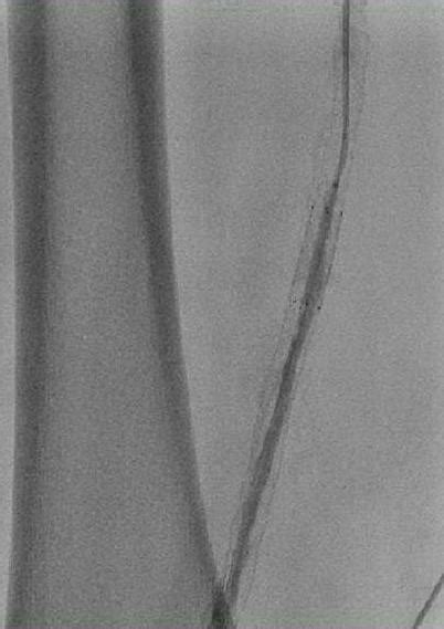 Angiogram Of The Right Sfa After Balloon Angioplasty Showing