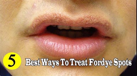 Will Fordyce Spots Go Away Naturally At Daniel Pinto Blog