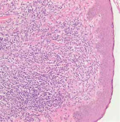 Detail Of The Lymphoid Infiltrate With Preserved Epidermis Hematoxylin