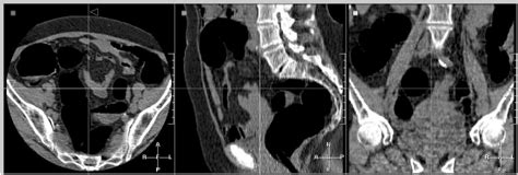 Three Orthogonal Views Of A Volumetric Ct Data Set Of The Colon