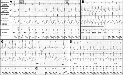A Intracardiac Electrogram Egm Demonstrating Initial Tachycardia Download Scientific Diagram