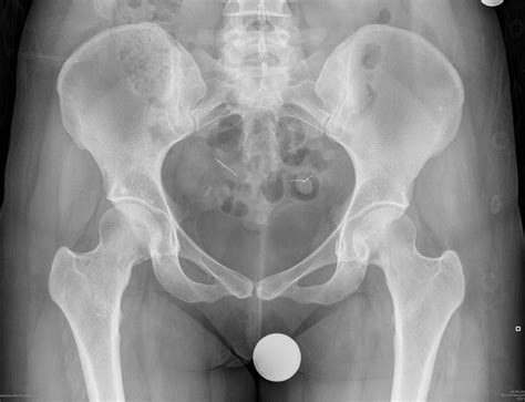 Medical Devices In The Abdomen And Pelvis Pacs