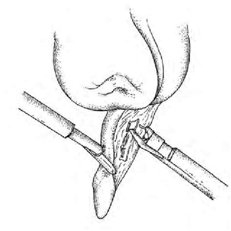 Operating Room Set Up For Diagnostic Laparoscopy And Appendicectomy Download Scientific Diagram