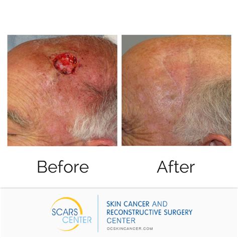 Skin Cancer Scalp Treatment