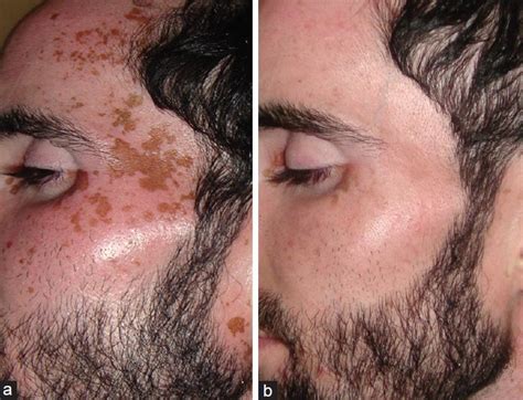 A Patchy Residual Pigmentation On Face B After Treatment With Download Scientific Diagram