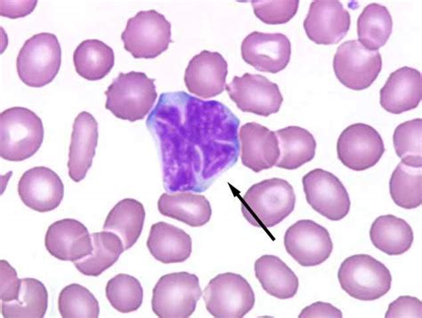 Cerebriform Nuclei Mycosis Fungoides Histology