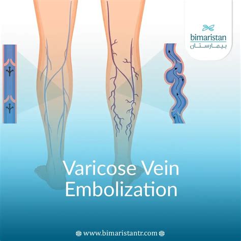 Varicose Vein Embolization In Turkey بيمارستان