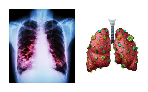 Contagious Or Not Navigating The Facts About Acute Bronchitis