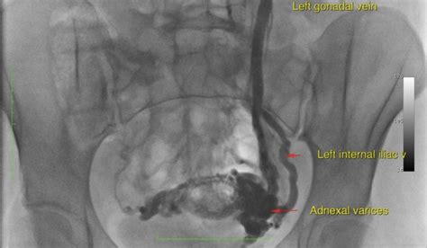 Ovarian Vein Embolisation For Pelvic Venous Congestion Syndrome
