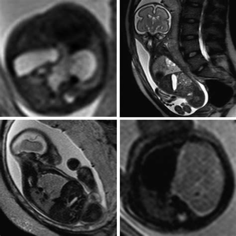 Fetal Mri Ad Axial B Sagittal And C Coronal T2 Weighted