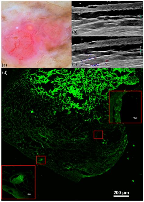Nodular Bcc Dermoscopy Shows Arborized Vessels And Shiny White Red