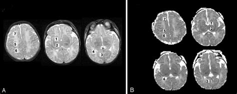 The Normal Neonatal Brain Mr Imaging Diffusion Tensor Imaging And 3d