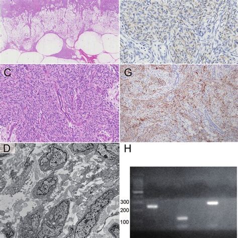 A Clinical Appearance Of The Tumour On The Left Buttock B A Poorly Download Scientific