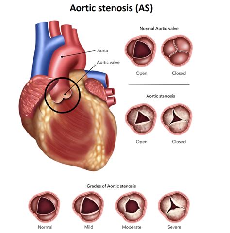 Normal Aortic Valve