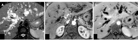Case Of Nodular Type Of Hilar Cholangiocarcinoma A Axial T2 Weighted Download Scientific