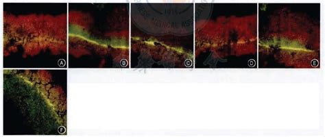Penetration Of Erythromycin ThroughStaphylococcus Epidermidi Chinese Medical Journal