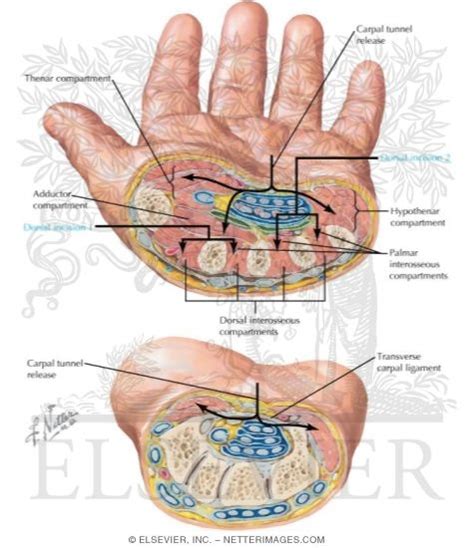 Section Through Metacarpal Bones Section Through Distal Carpal Bones